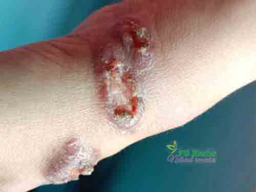 Ubat sporotrichosis manusia PS Herbs - mudah dan cepat sembuh • PS Herbs