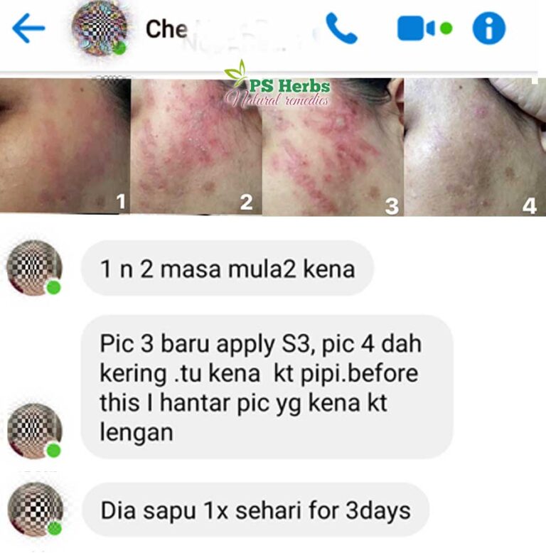 Testimoni - kudis gigitan semut charlie tiga hari sembuh • PS Herbs