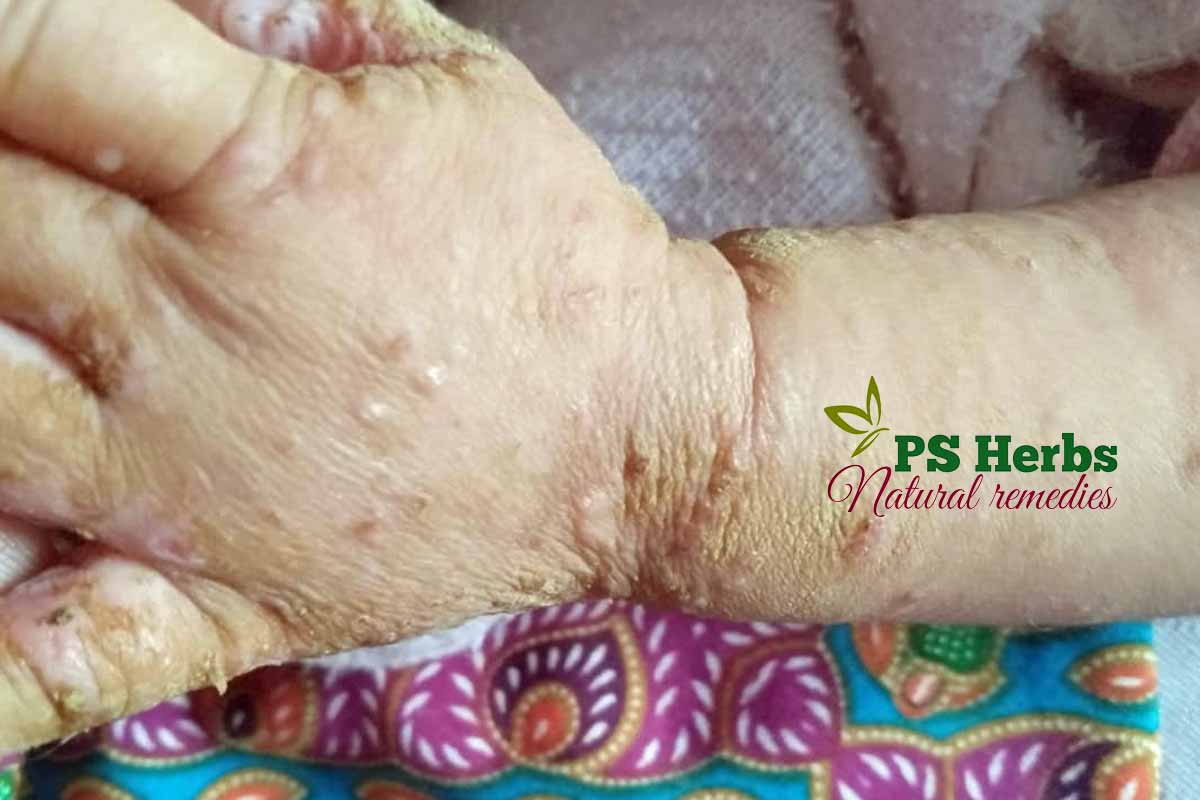 Tanda tanda kudis buta, jenis, cara berjangkit dan cara mengendali • PS ...
